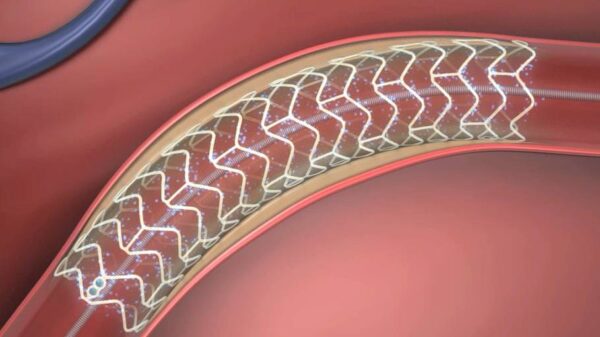 CHE COS’E’ LO STENT CORONARICO E A COSA SERVE? – Studio Cardiologico ...