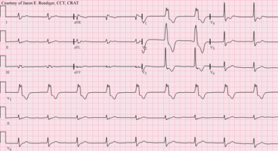 COSA SONO LE EXTRASISTOLI? – DIAGNOSI E CURA – Studio Cardiologico Dott ...