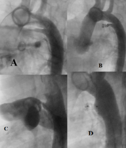 DOTTO DI BOTALLO PERVIO : CHE COS’E’ , COME DIAGNOSTICARLO E QUAL E’ LA ...