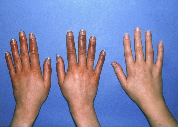 L’ACROCIANOSI: FORME,CAUSE,SINTOMI,DIAGNOSI E TERAPIA – Studio ...