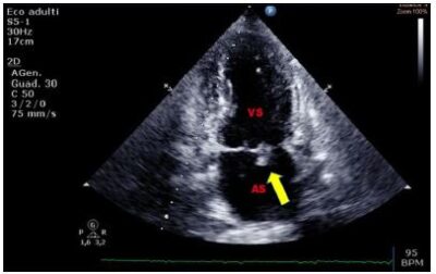 IL MIXOMA ATRIALE, IL TUMORE CARDIACO PER DEFINIZIONE – Studio ...
